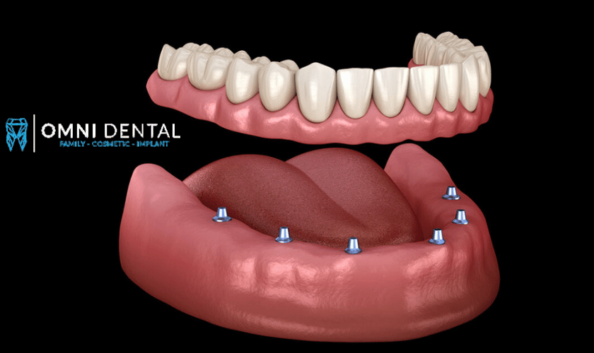 What Are Overdentures and How They Work?