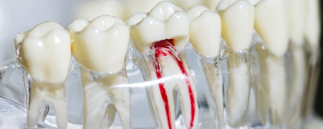 Foods to Eat and Avoid Post-Root Canal Treatment